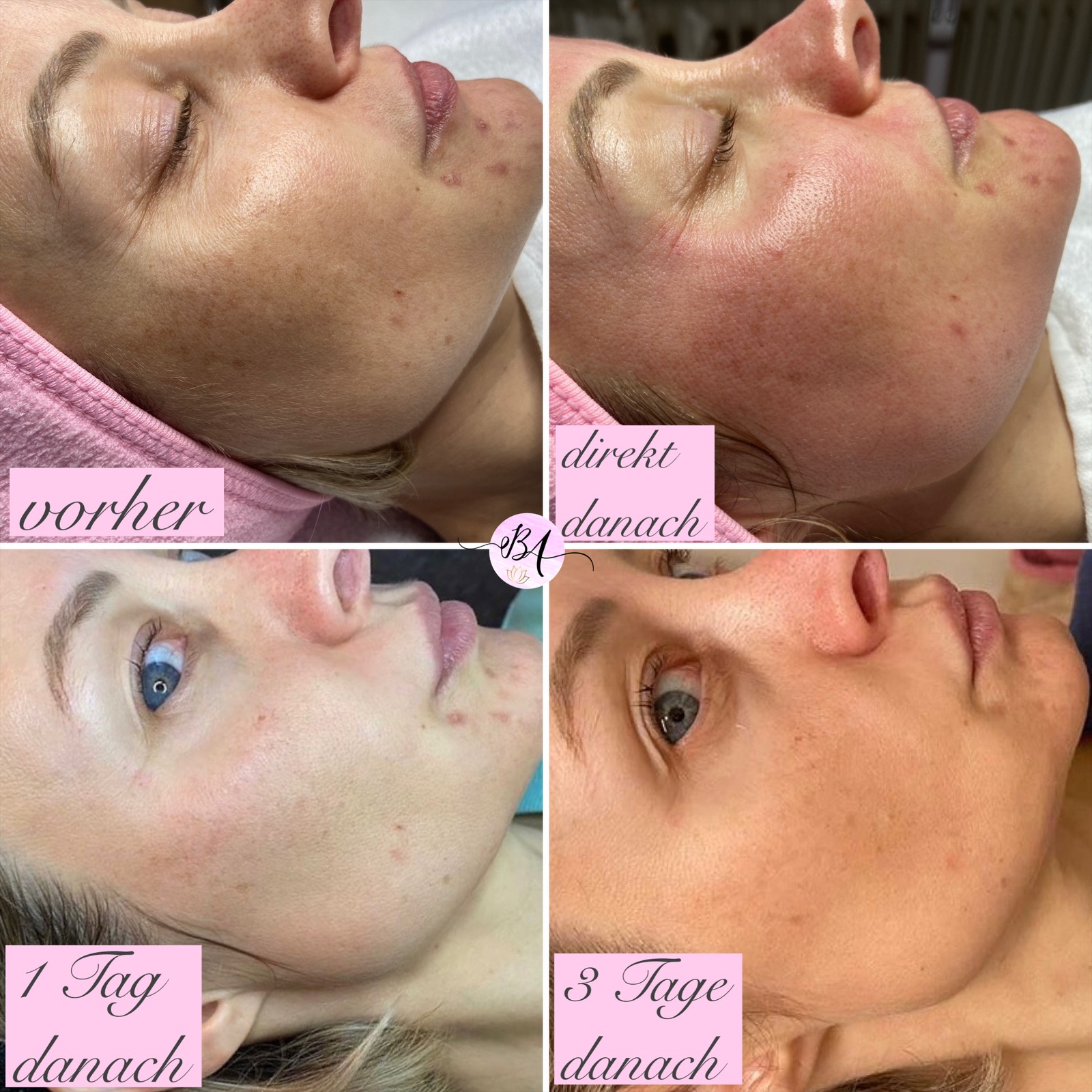 Microneedling Tranensacke Vorher Nachher
